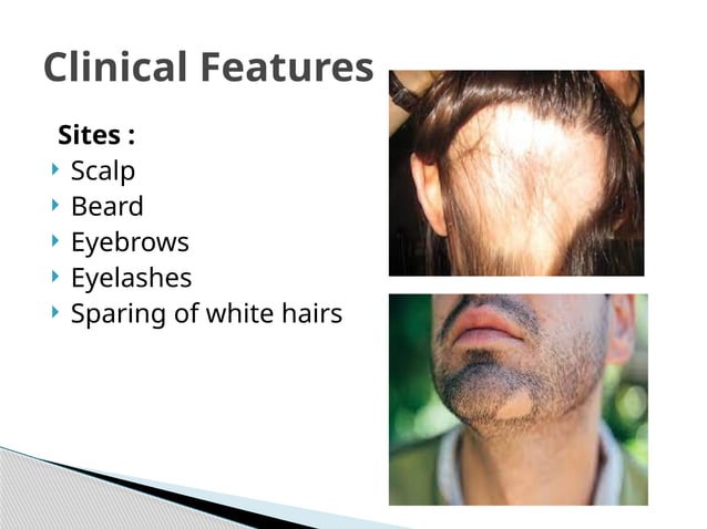 Acquired disorders of hair shaft by amna.pptx