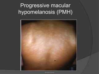Progressive Macular Hypomelanosis