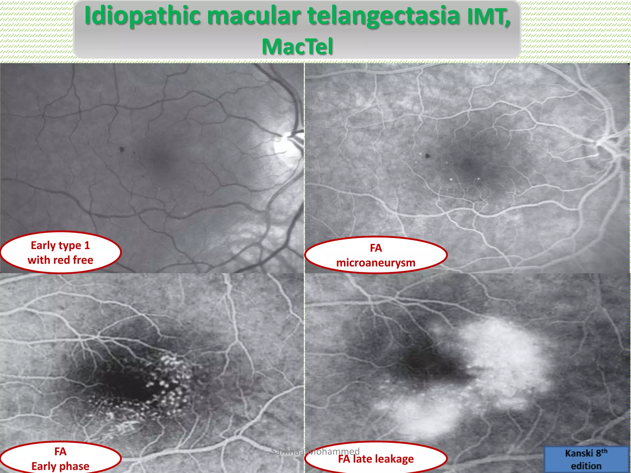 Acquired macular diseases | PPTX