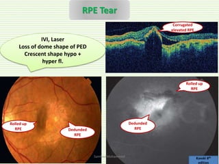 Acquired macular diseases | PPTX