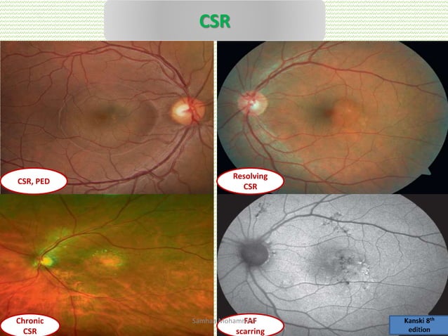 Acquired macular diseases | PPTX