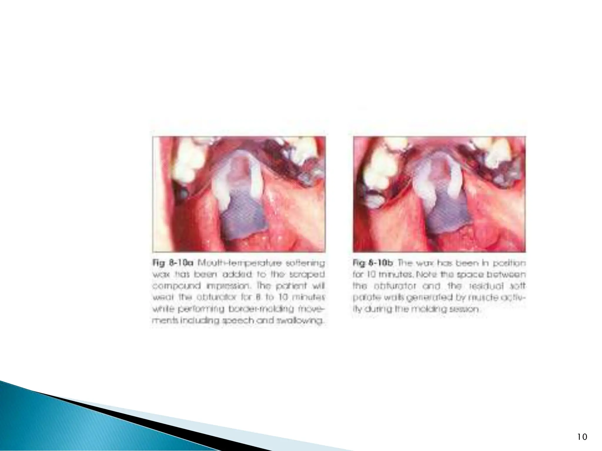 Acquired maxillary defects copy removeable | PPT