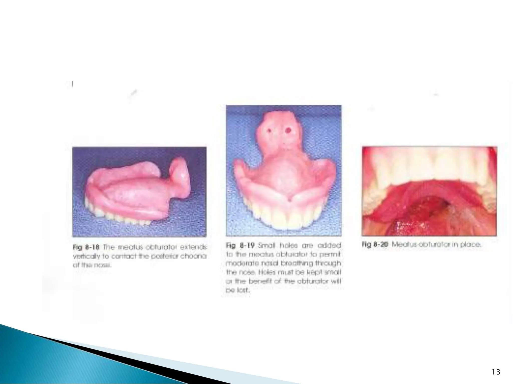 Acquired maxillary defects copy removeable | PPT