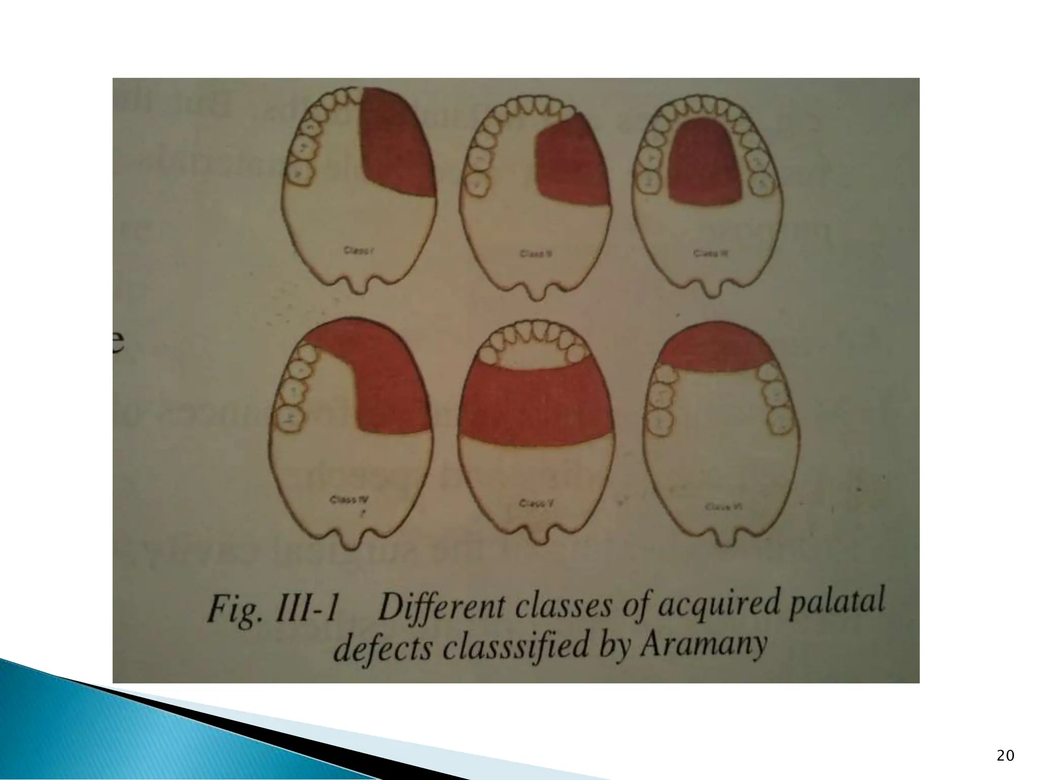 Acquired maxillary defects copy removeable | PPT