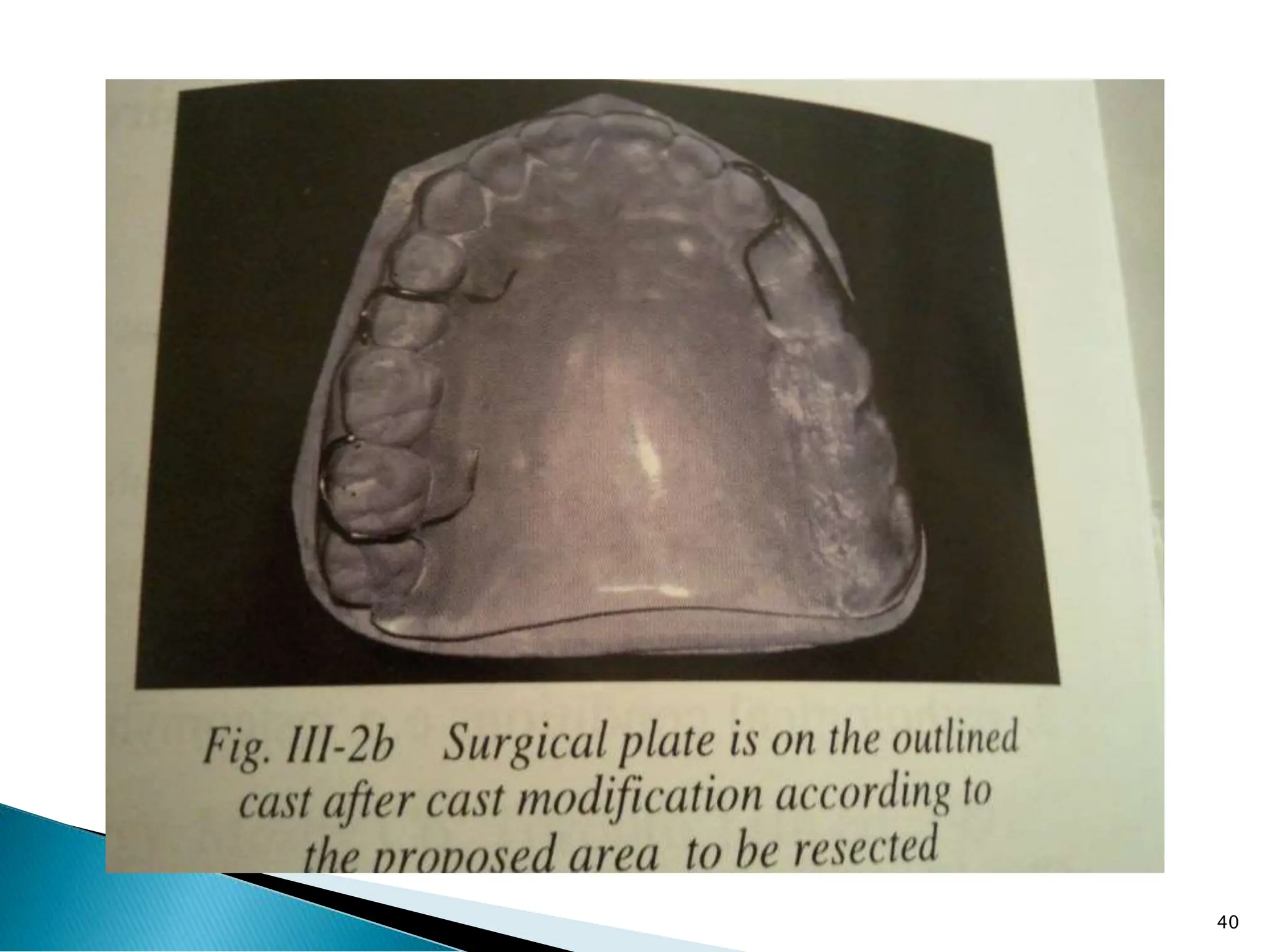 Acquired maxillary defects copy removeable | PPT