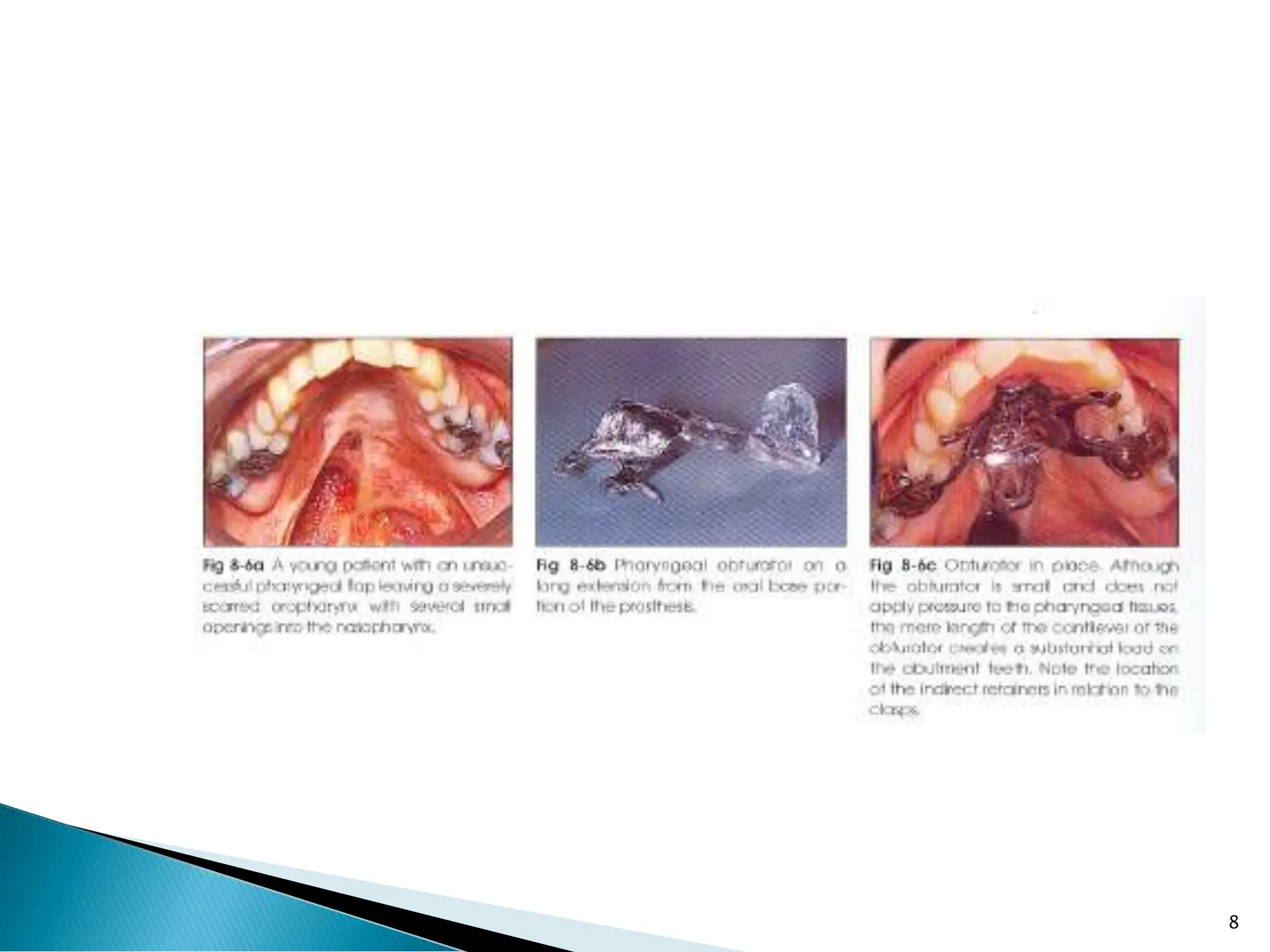 Acquired maxillary defects copy removeable | PPT