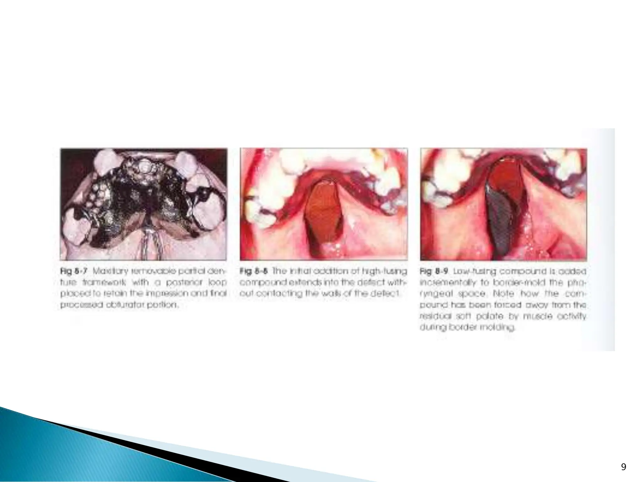 Acquired maxillary defects copy removeable | PPT