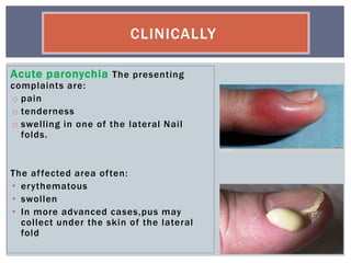 Acquired nail dis part | PPTX