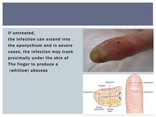 Acquired nail dis part | PPTX