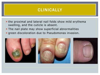 Acquired nail dis part | PPT
