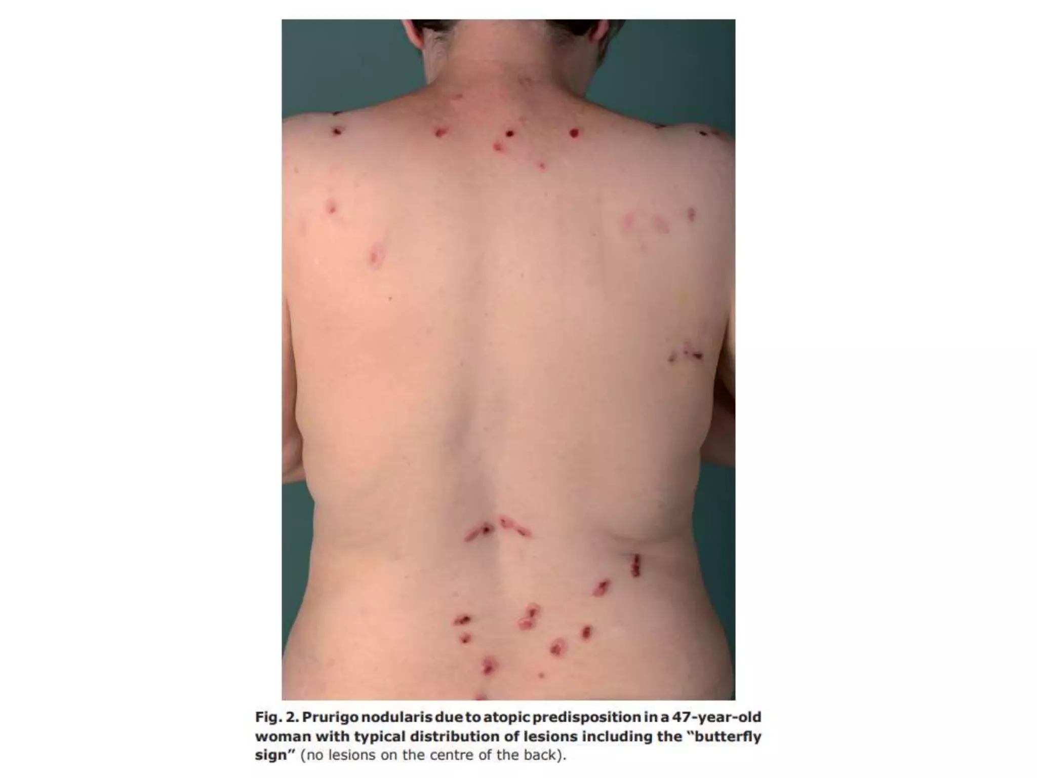Acquired perforating dermatosis and lichen amyloidosis | PPTX