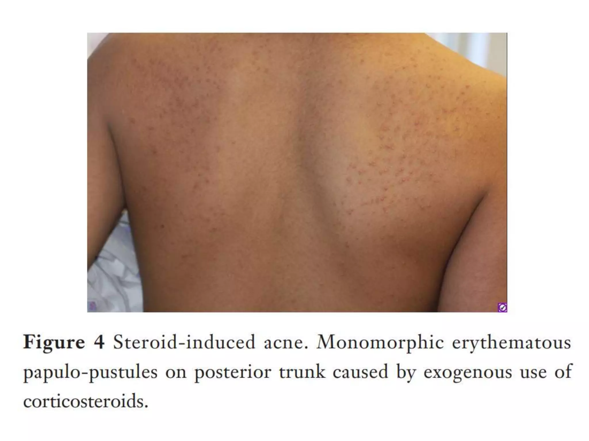 Acquired perforating dermatosis and lichen amyloidosis | PPTX