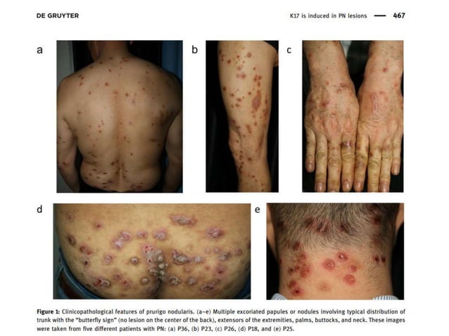 Acquired perforating dermatosis and lichen amyloidosis | PPTX
