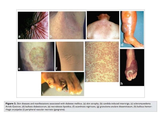 Acquired perforating dermatosis and lichen amyloidosis | PPT | Free ...