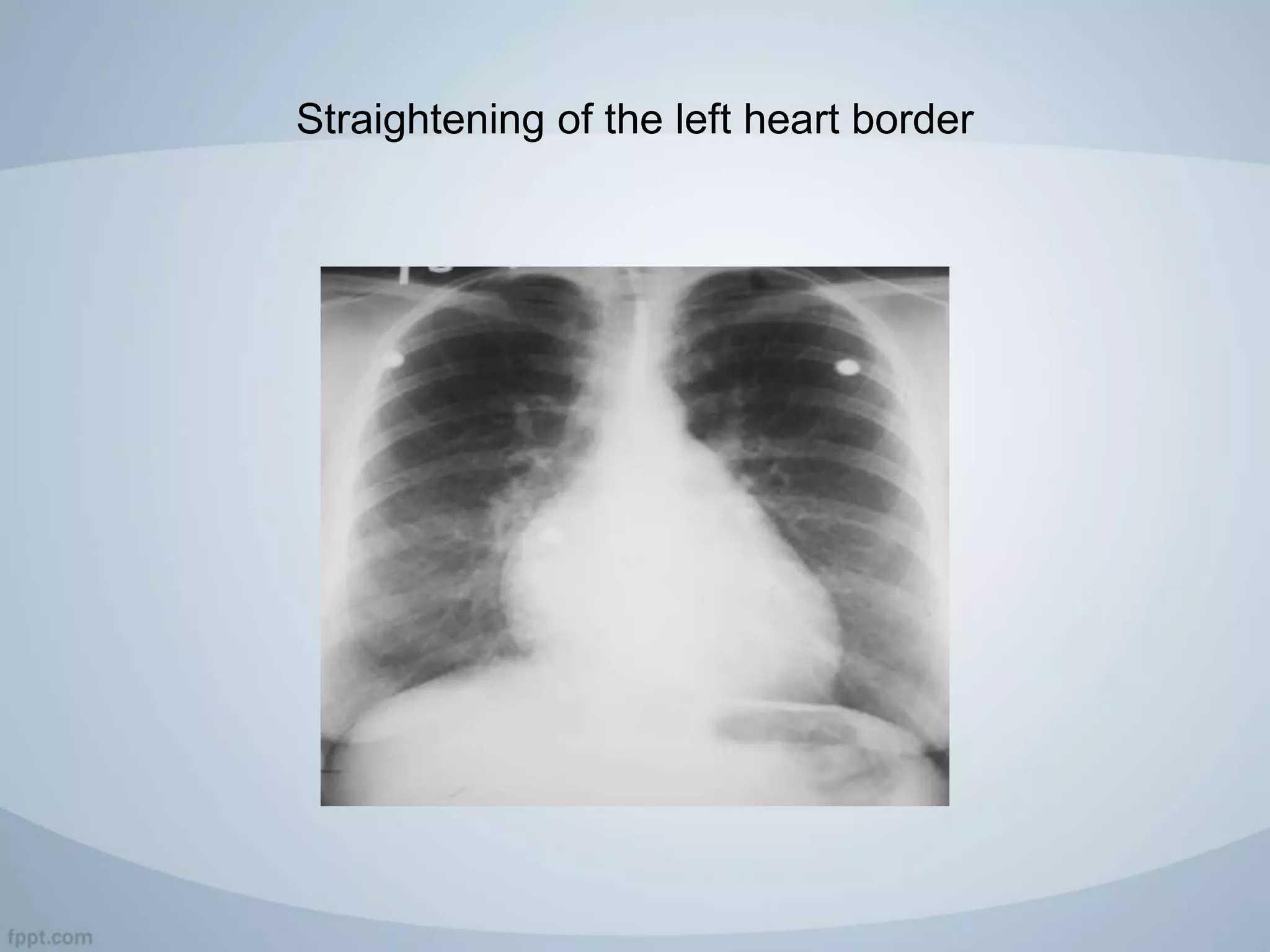 Acquired valvular heart diseases with x ray findings | PPTX