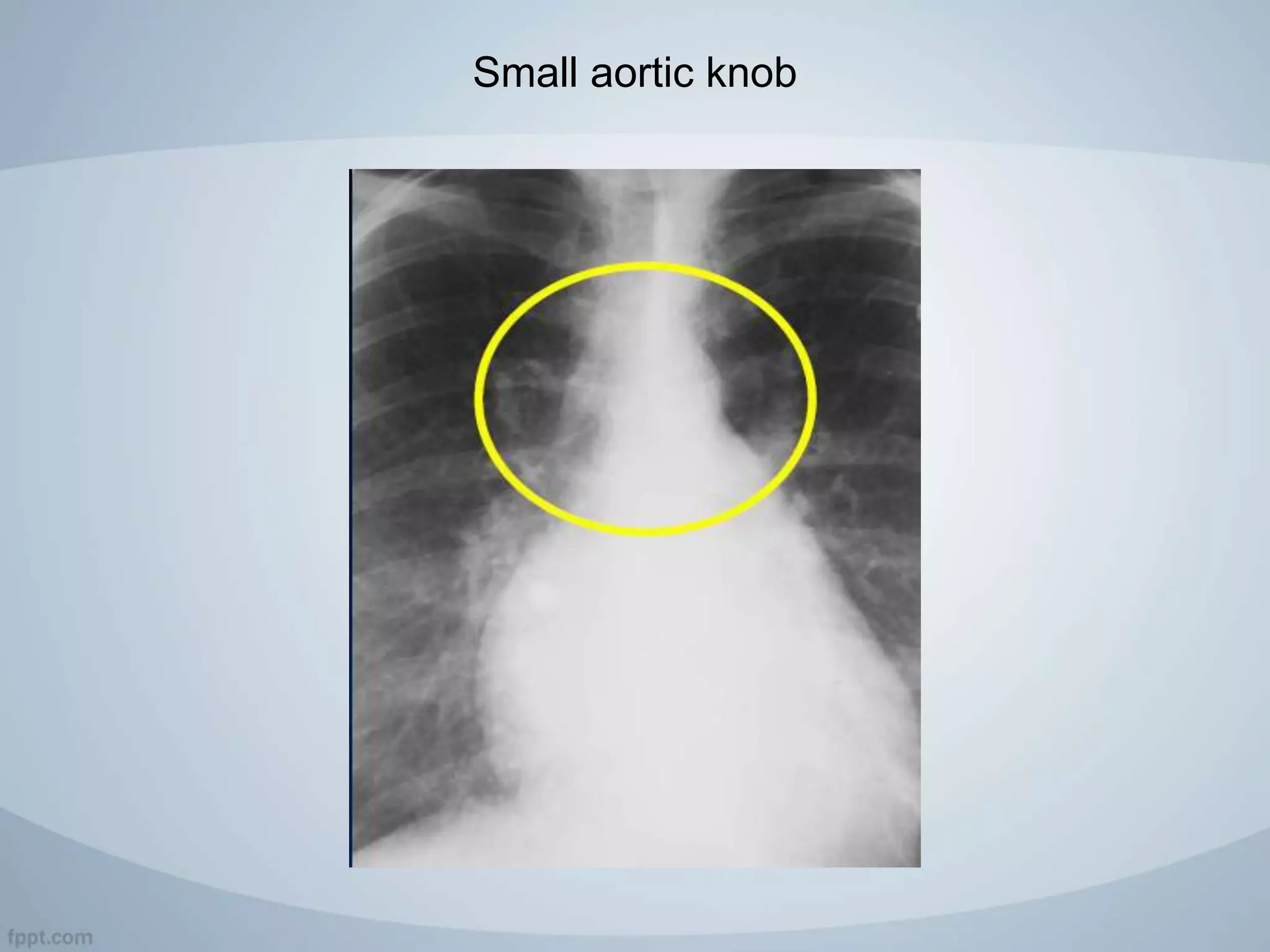Acquired valvular heart diseases with x ray findings | PPTX