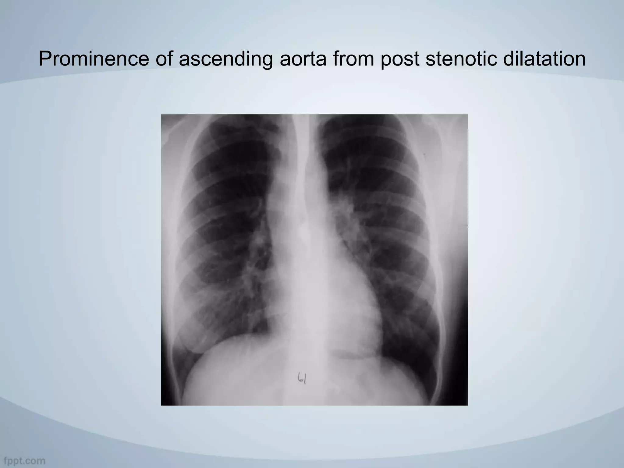 Acquired valvular heart diseases with x ray findings | PPTX