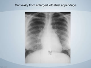 Acquired valvular heart diseases with x ray findings | PPTX