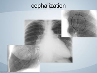 Acquired valvular heart diseases with x ray findings | PPTX