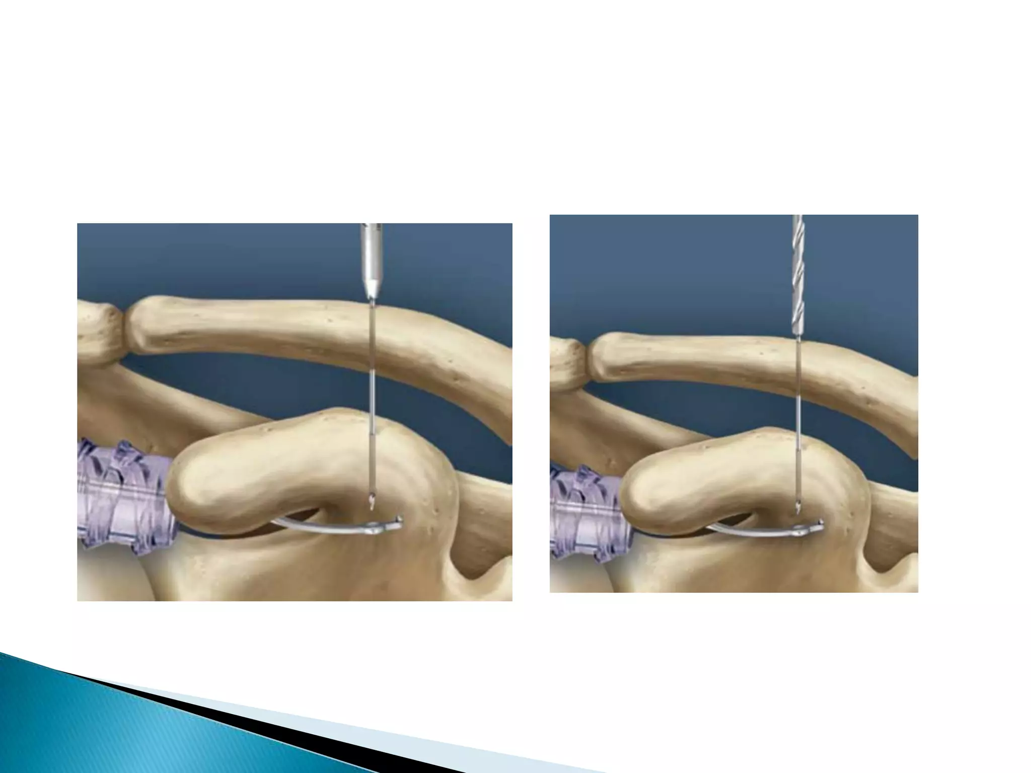 Aacromio clavicular reconstruction | PPT