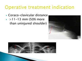 Aacromio clavicular reconstruction | PPT