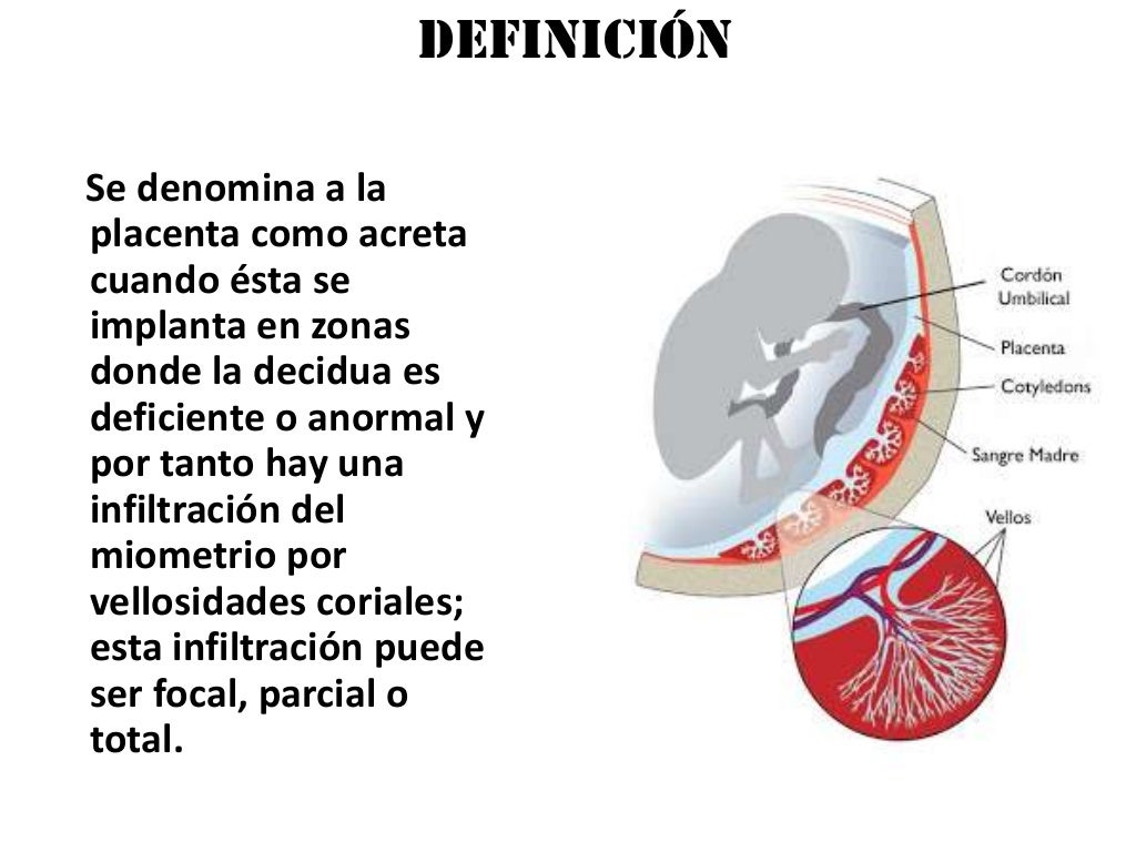 Acretismo Placentario