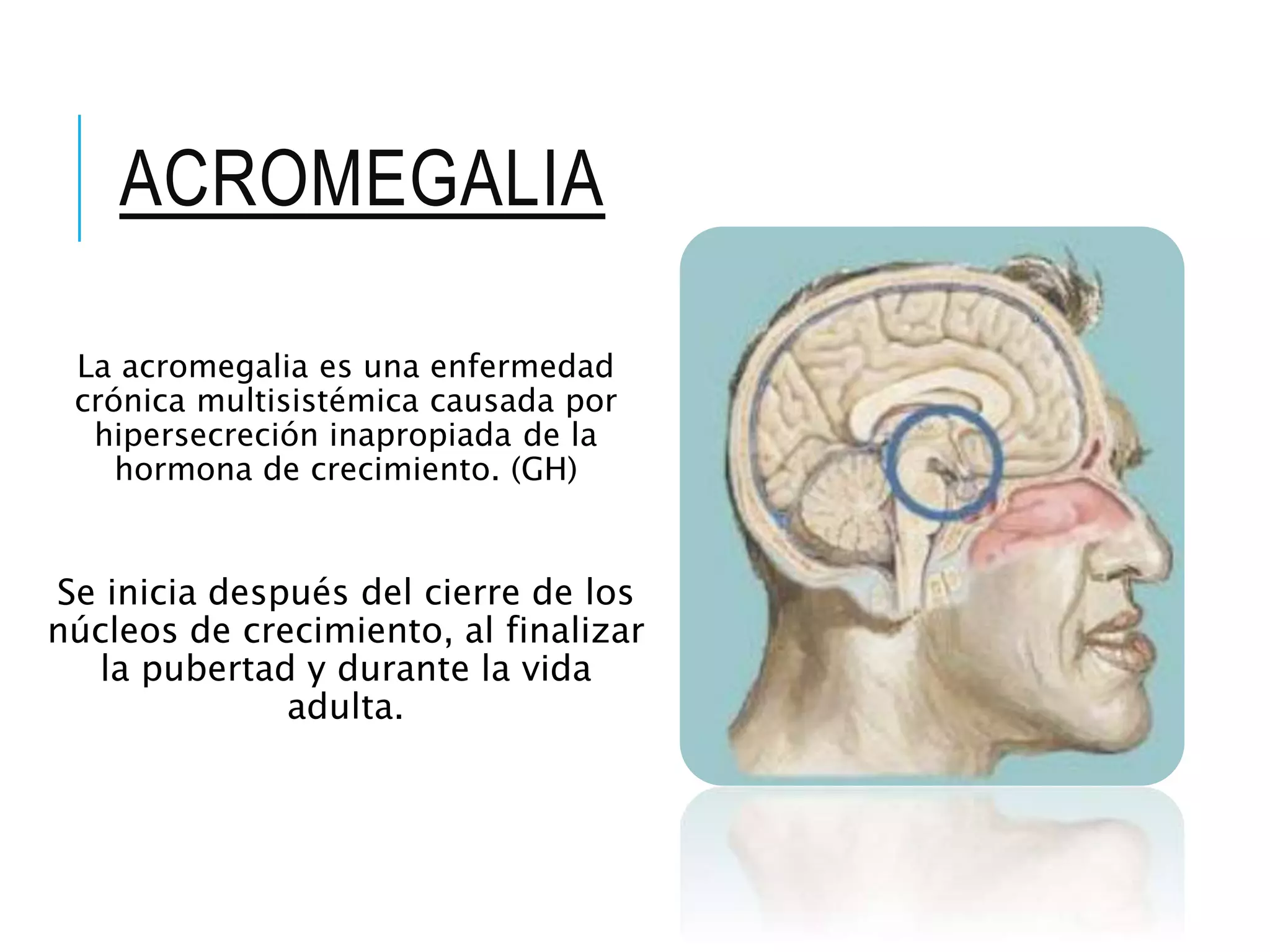 Acromegalia | PPTX