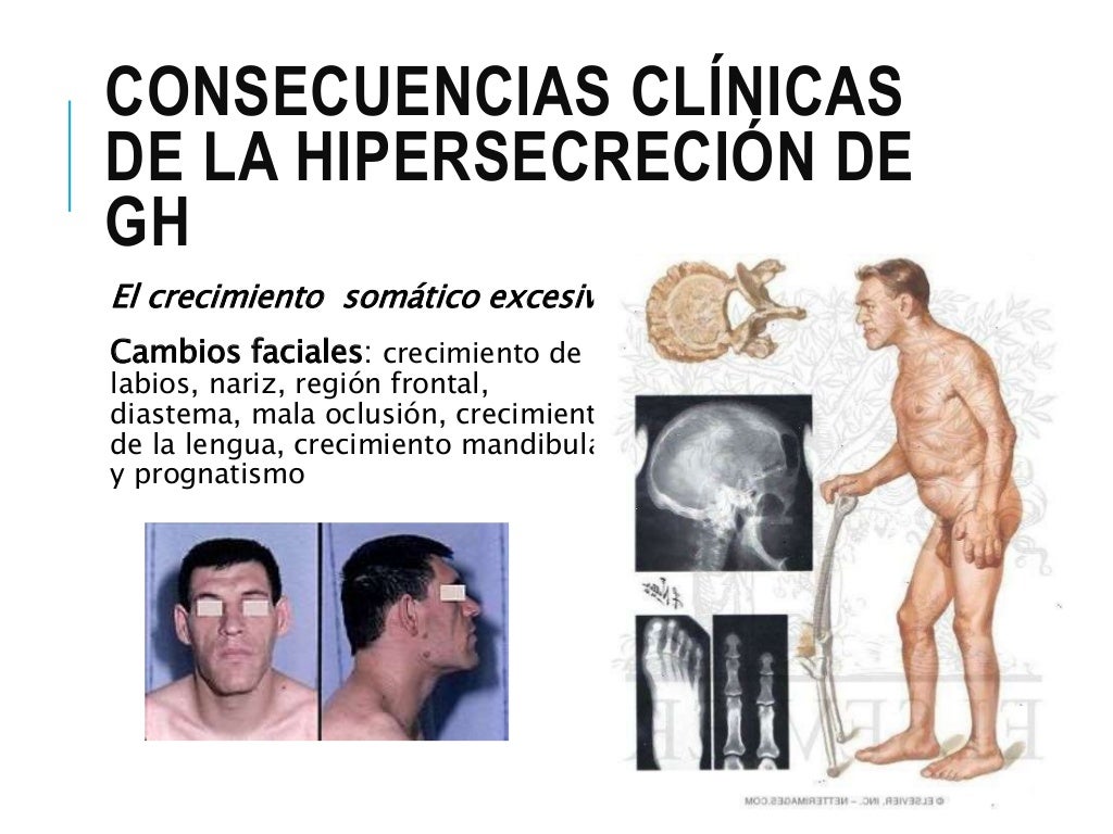 Acromegalia