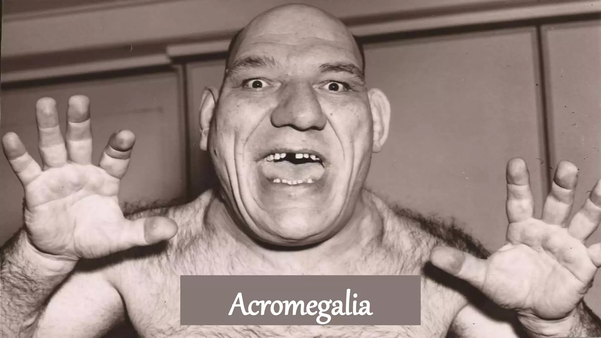 Acromegalia | PPT
