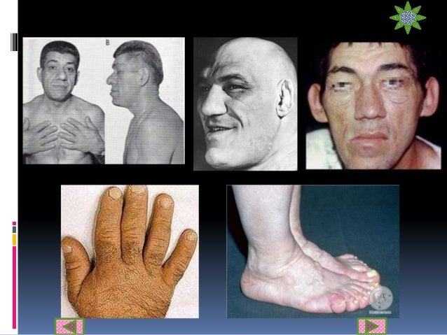 Causas Do Gigantismo Hipofisario