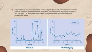 acromegaly desease because of excess gh | PPTX