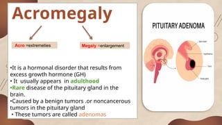 acromegaly desease because of excess gh | PPTX