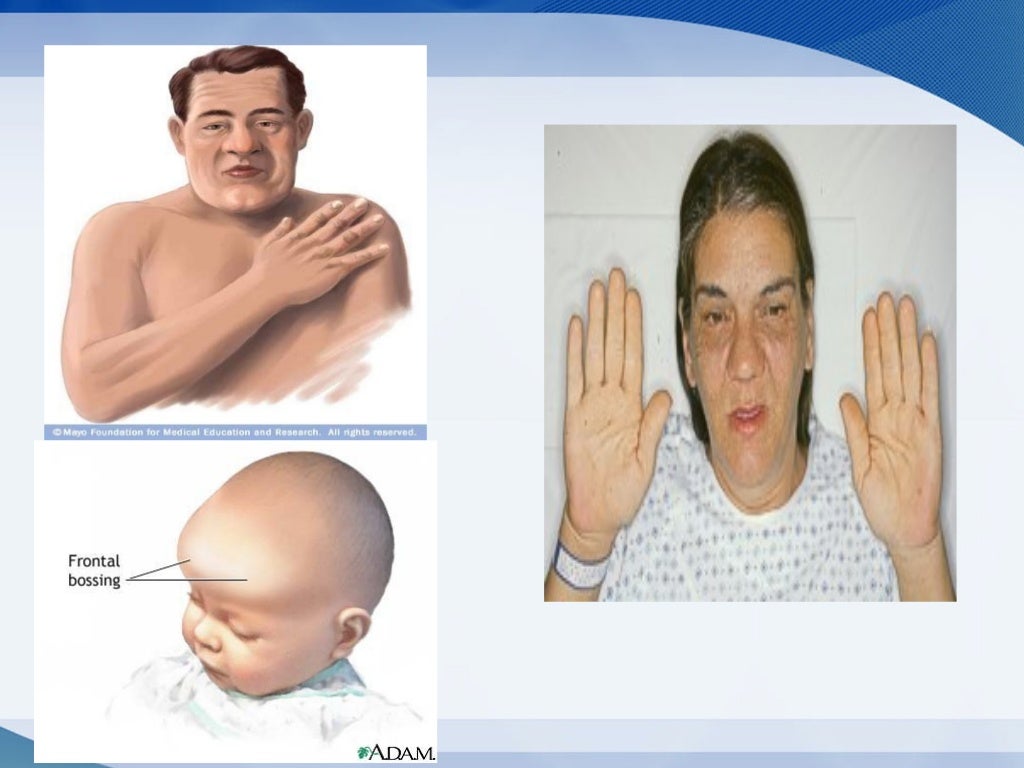 Acromegaly