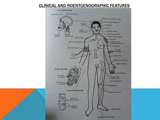 Acromegaly-pathogenesis | PPTX