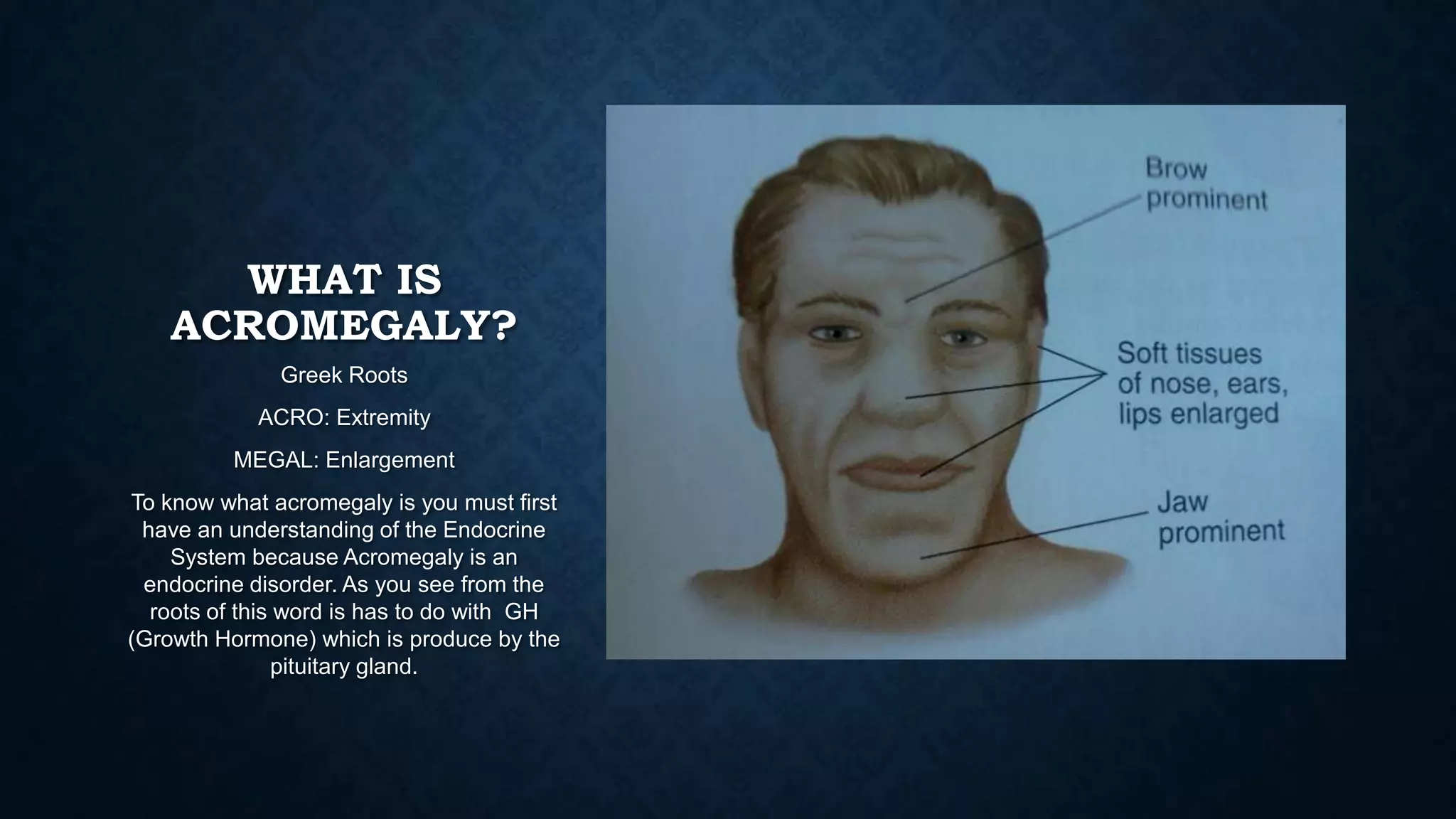 Acromegaly | PPT