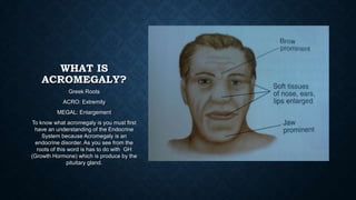 Acromegaly | PPTX