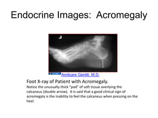 Acromegaly | PPTX