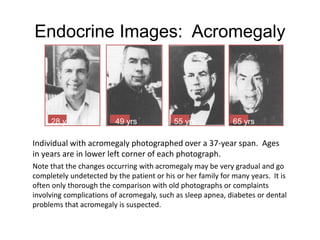 Acromegaly | PPT
