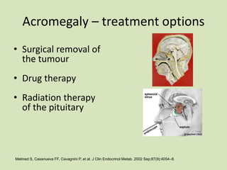 Acromegaly | PPSX