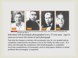 Acromegaly Guidelines 2014 | PPT