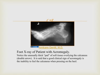 Acromegaly Guidelines 2014 | PPTX
