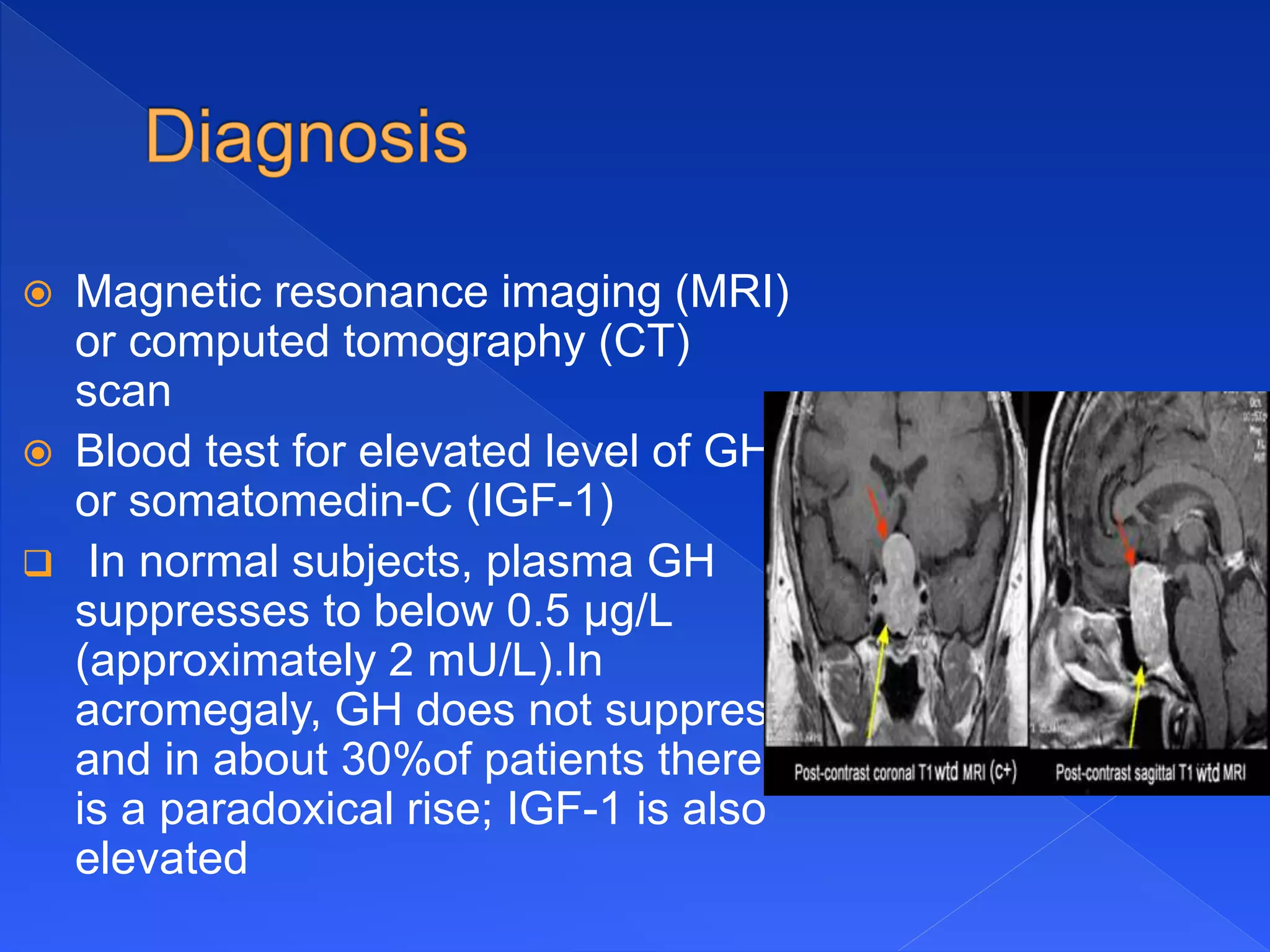 Acromegaly | PPTX