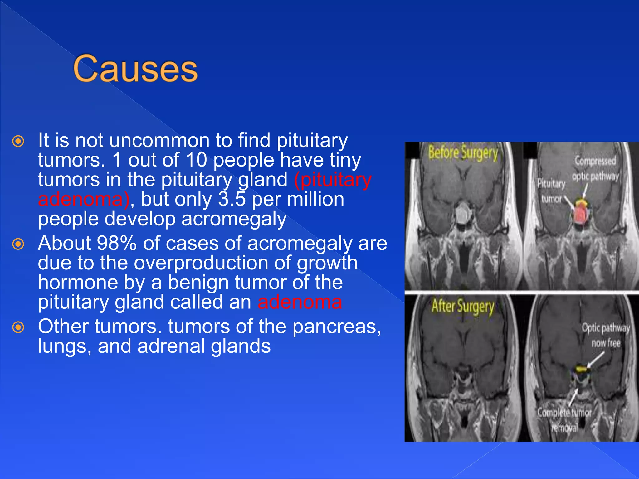 Acromegaly | PPTX