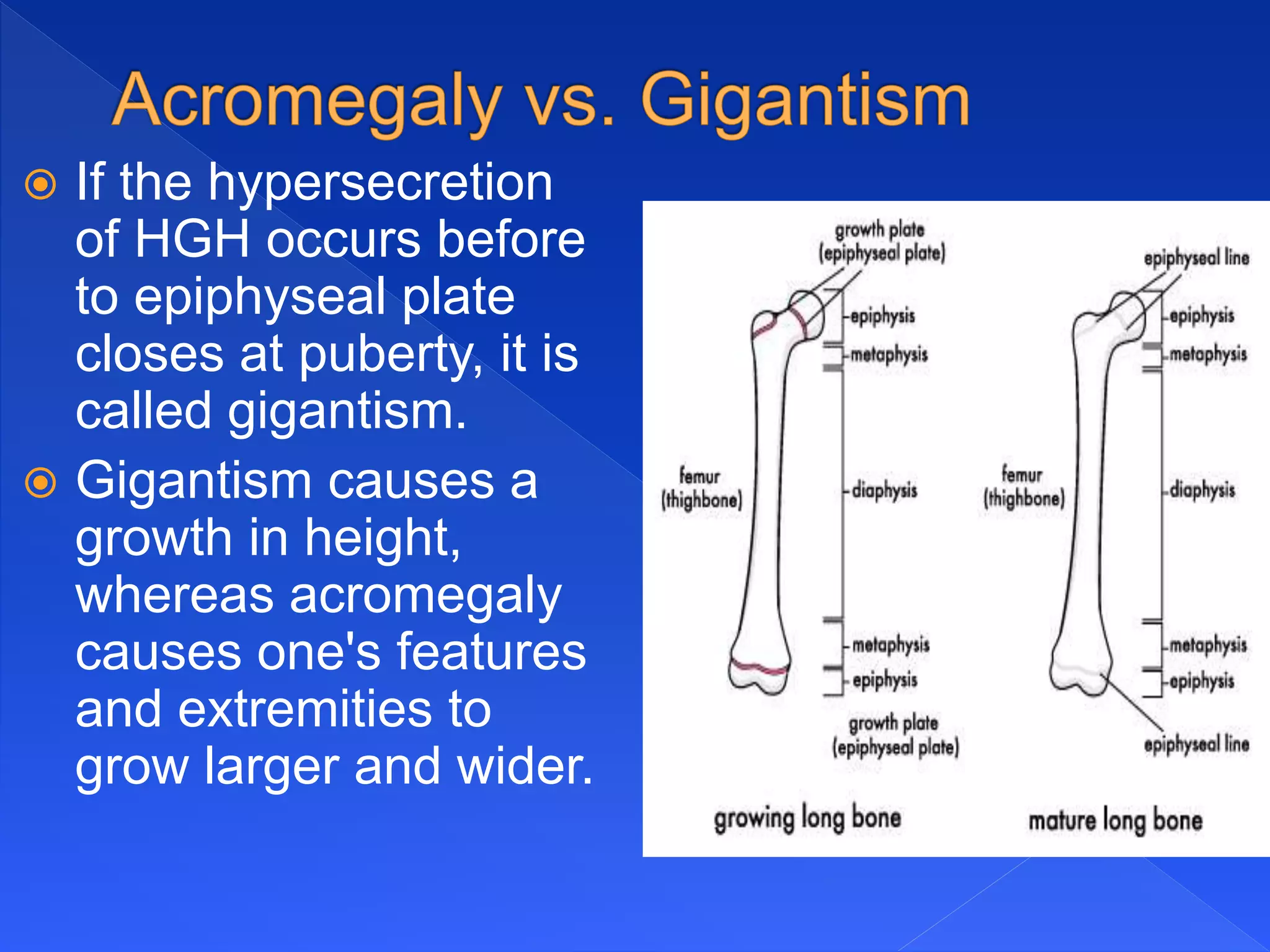 Acromegaly | PPTX