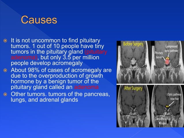 Acromegaly | PPTX