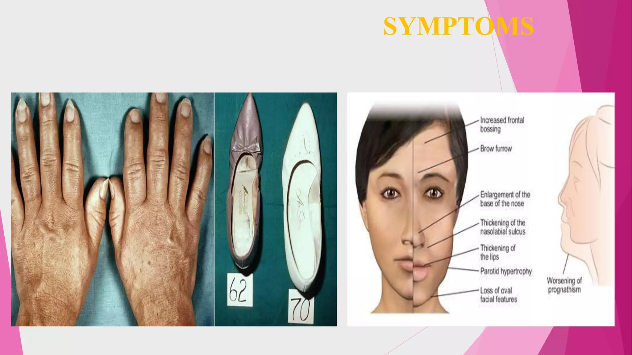 Acromegaly | PPTX