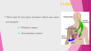 Acromegaly | PPTX