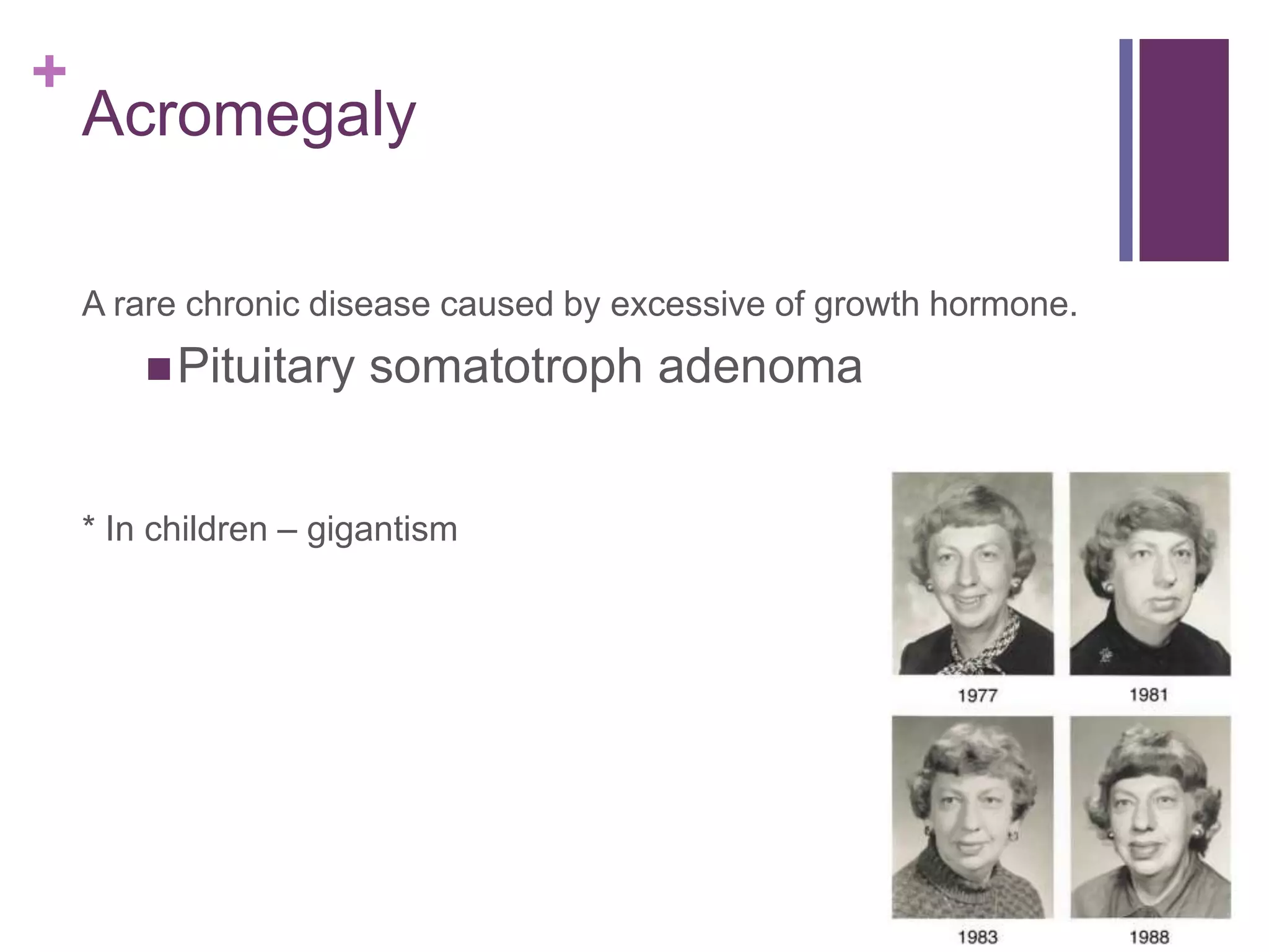 Clinical Case (Acromegaly) | PPTX