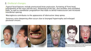 Acromegaly.pptx
