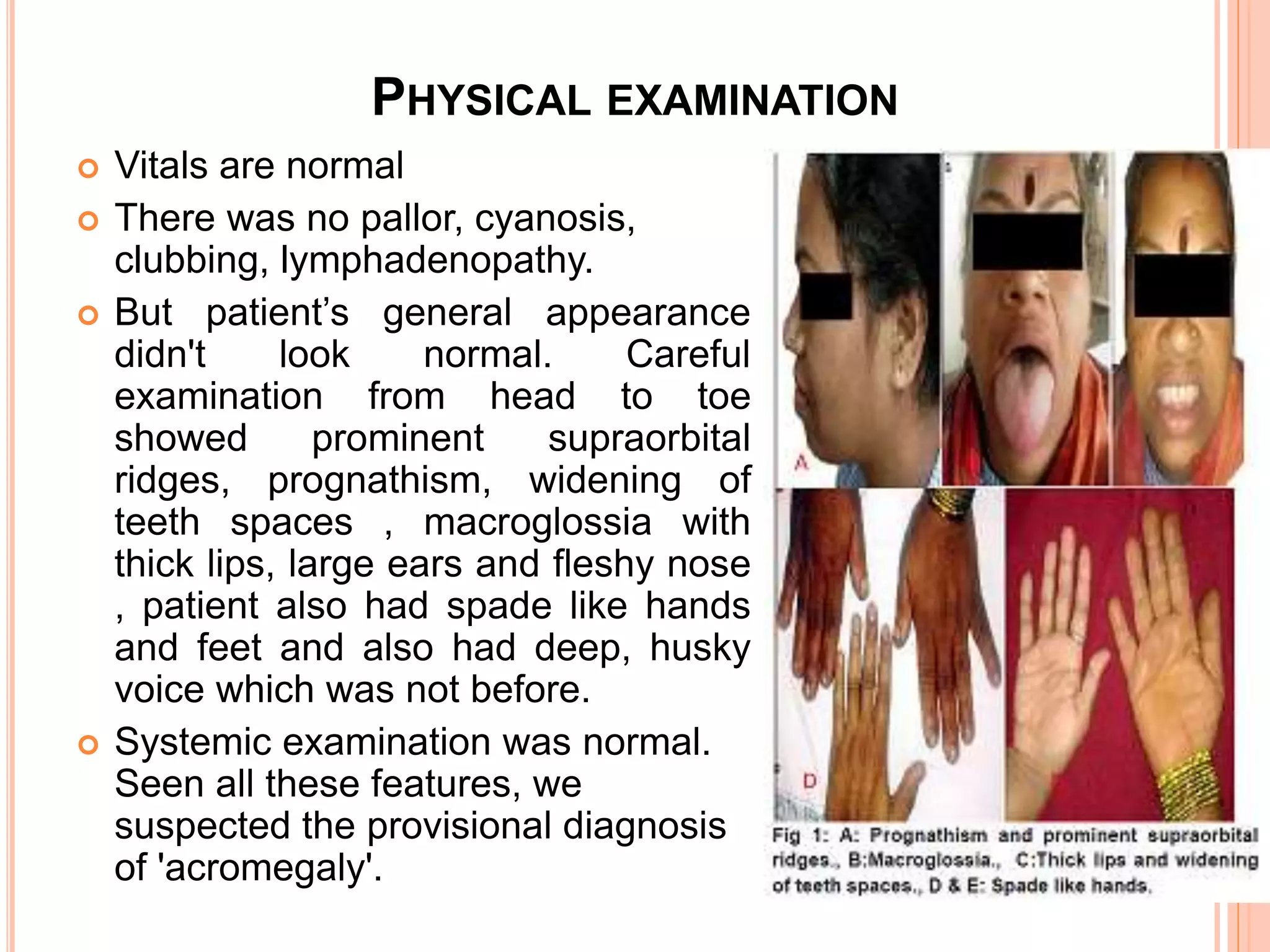 Acromegaly.pptx